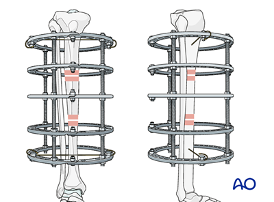 Ring fixation for Multifragmentary fracture, intact segmental