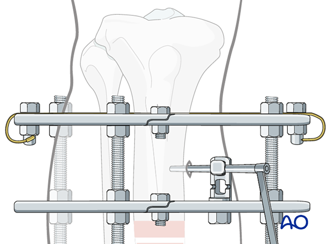 Ring fixation for Multifragmentary fracture, intact segmental
