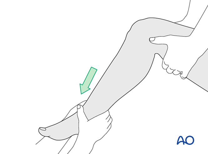 Uniplanar external fixation for Simple fracture, transverse