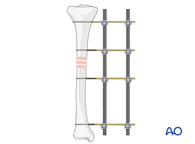 Uniplanar external fixation for Simple fracture, oblique