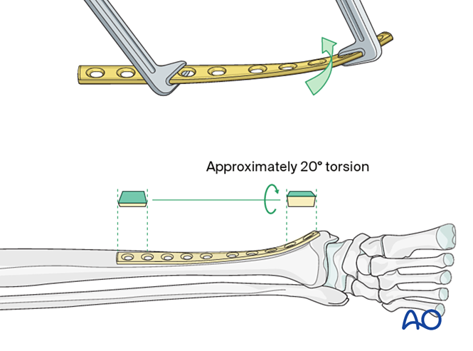 ORIF - Lag screws through protection plate for Simple fracture, spiral