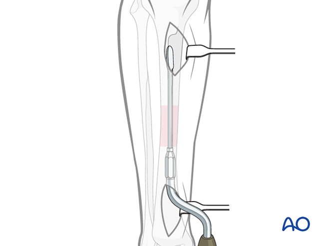 MIO - Compression plating for Simple fracture, transverse