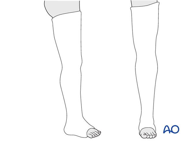 Nonoperative treatment (casting) for Simple fracture, oblique