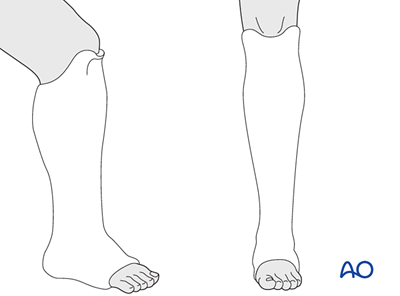 Nonoperative treatment (casting) for Simple fracture, oblique