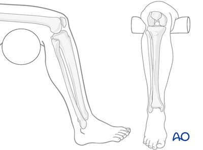 Nonoperative treatment (casting) for Wedge fracture, fragmented wedge