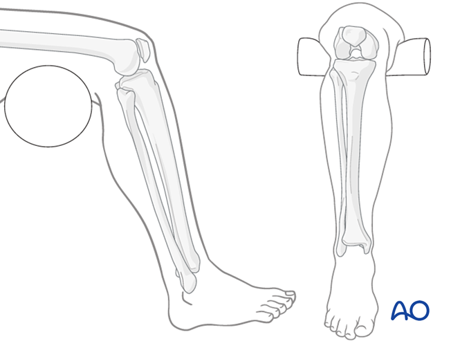 Nonoperative treatment (casting) for Simple fracture, transverse