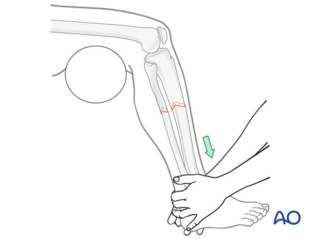 Nonoperative treatment (casting) for Simple fracture, transverse