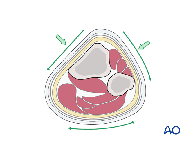 Nonoperative treatment (casting) for Simple fracture, transverse
