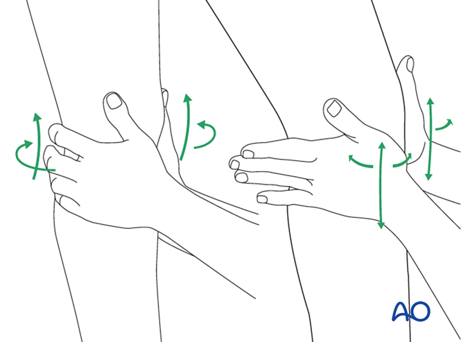 Nonoperative treatment (casting) for Simple fracture, transverse