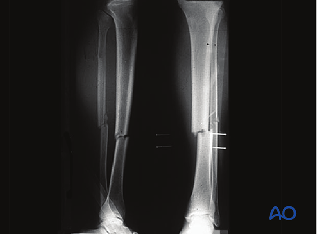 Nonoperative treatment (casting) for Simple fracture, oblique