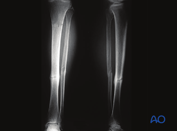 Nonoperative treatment (casting) for Simple fracture, oblique
