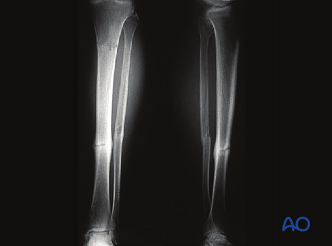 Nonoperative treatment (casting) for Wedge fracture, fragmented wedge