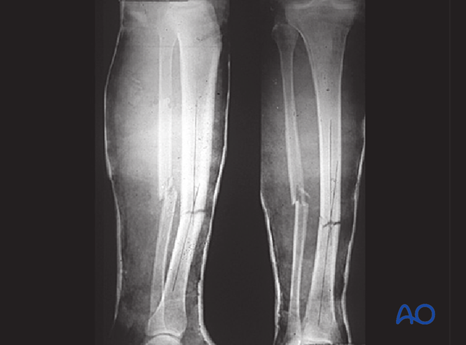 Nonoperative treatment (casting) for Simple fracture, transverse