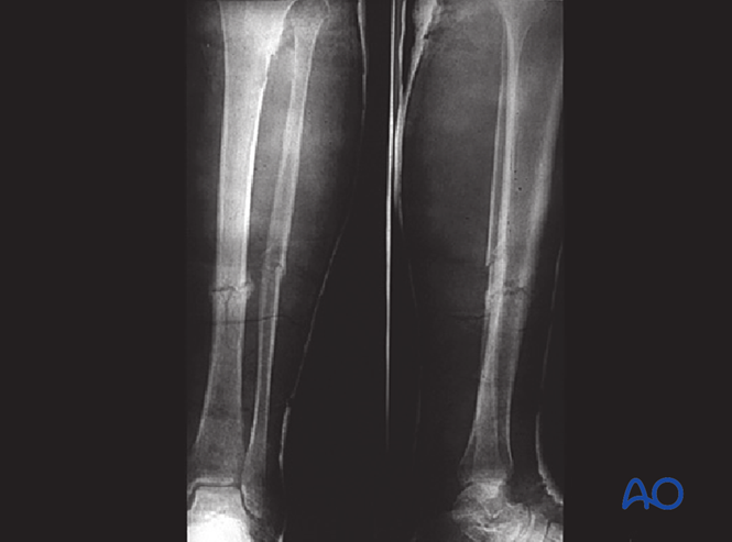 Nonoperative treatment (casting) for Wedge fracture, fragmented wedge