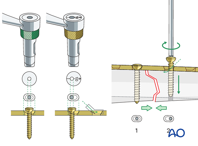 ORIF - Compression plating for Simple fracture, transverse