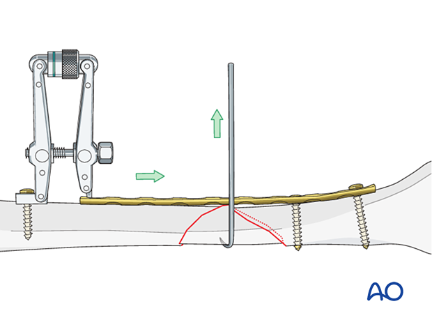 ORIF - Compression plating for Wedge fracture, intact wedge