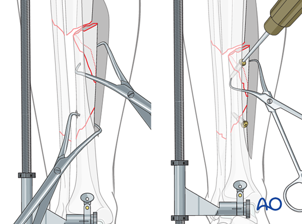 ORIF - Lag screws with protection plate for Multifragmentary fracture ...