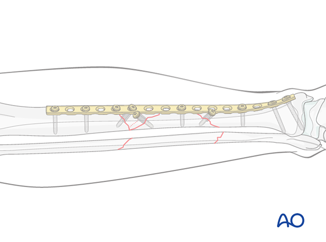 ORIF - Lag screws with protection plate for Multifragmentary fracture ...
