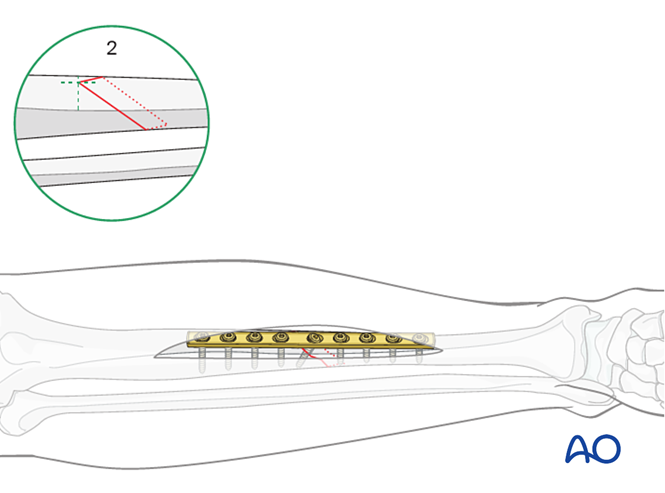 ORIF - Compression plate with lag screw for Simple fracture, oblique