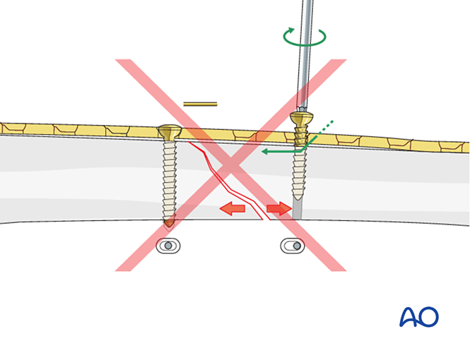 ORIF - Compression plate with lag screw for Simple fracture, oblique