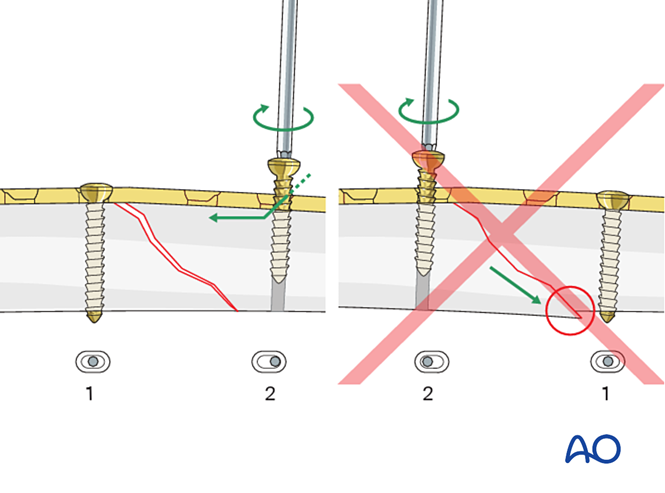 ORIF - Compression plate with lag screw for Simple fracture, oblique