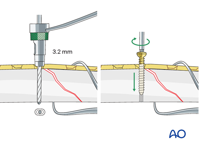 ORIF - Compression plate with lag screw for Simple fracture, oblique