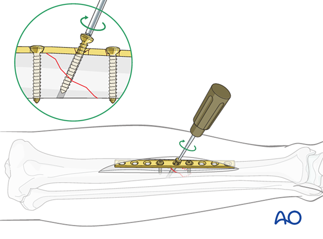 ORIF - Compression plate with lag screw for Simple fracture, oblique