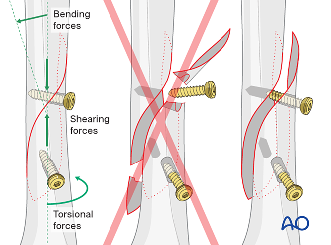 ORIF - Lag screws outside protection plate for Simple fracture, spiral