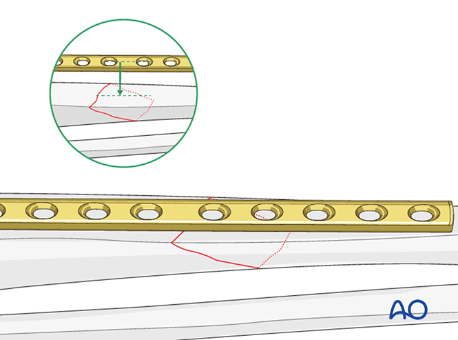 ORIF - Lag screws outside protection plate for Simple fracture, oblique