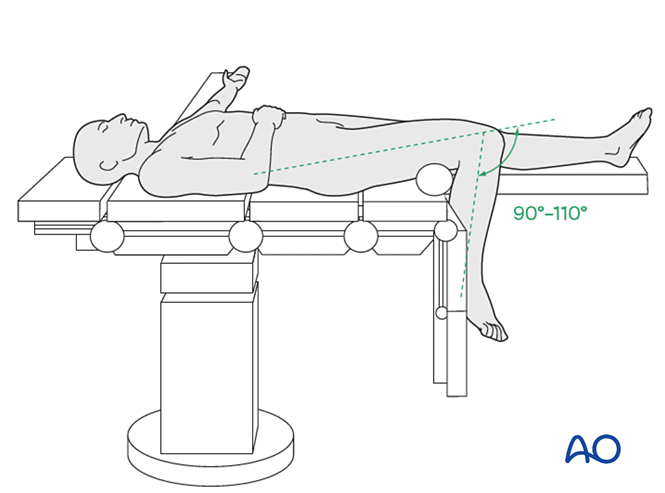 Flexed knee position for intramedullary nailing