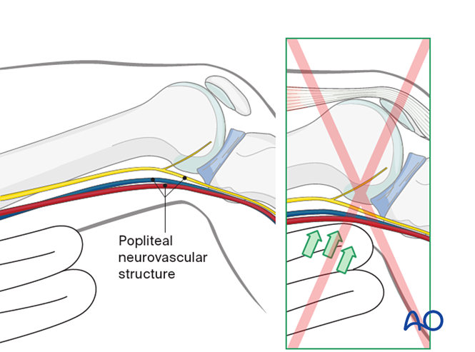 Flexed knee position for intramedullary nailing