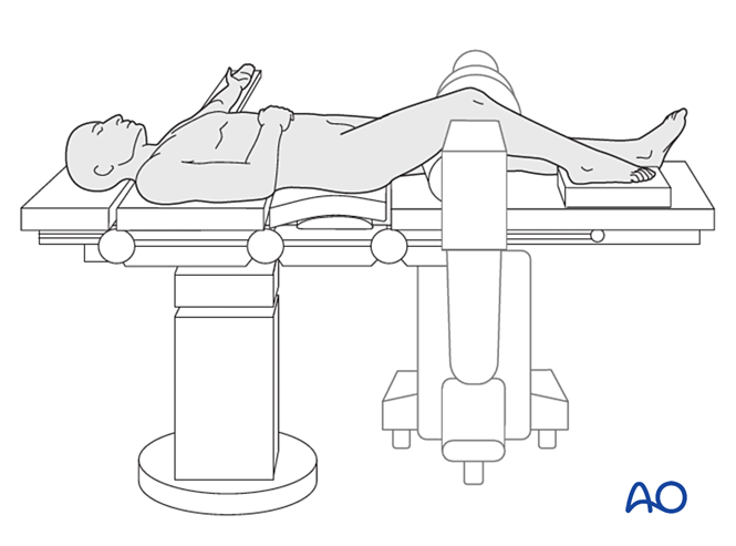 Semi-extended knee position for intramedullary nailing