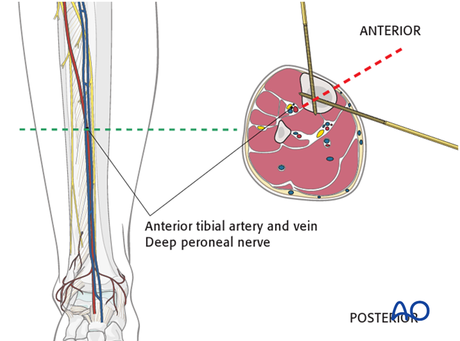 Safe zones of the tibia for pin insertion