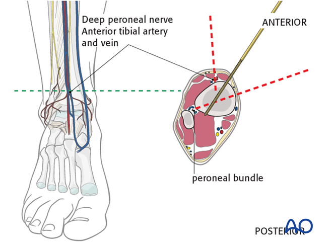 Safe zones in the tibia for pin insertion
