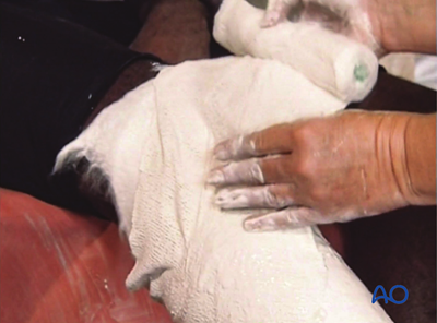 Fracture management with limited resources