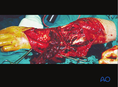 Principles of management of open fractures