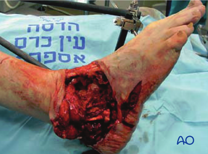 Principles of management of open fractures