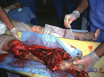 Principles of management of open fractures