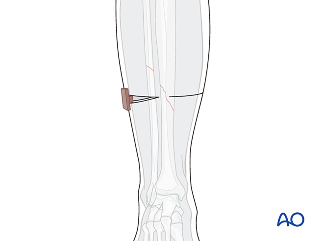 Fracture management with limited resources