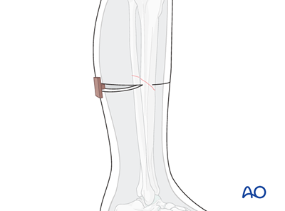 Fracture management with limited resources