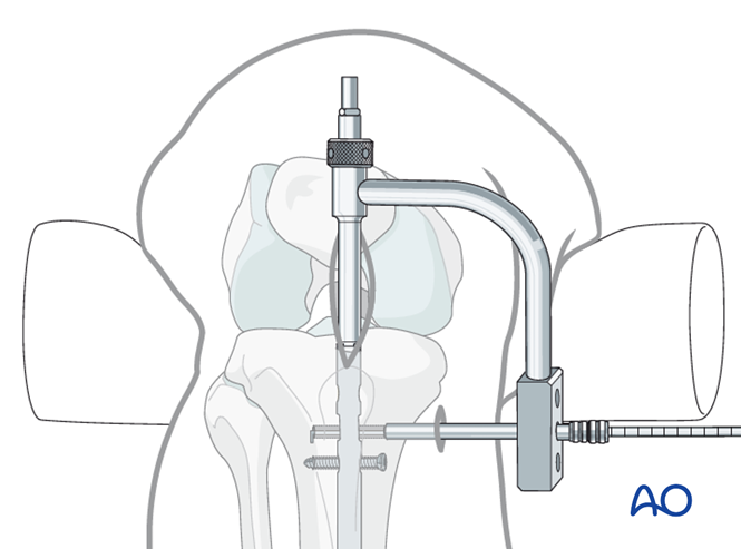 Nailing without image intensification