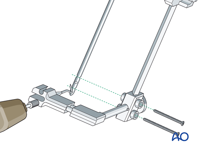 Nailing without image intensification
