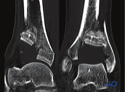 Anteromedial approach to the distal tibia