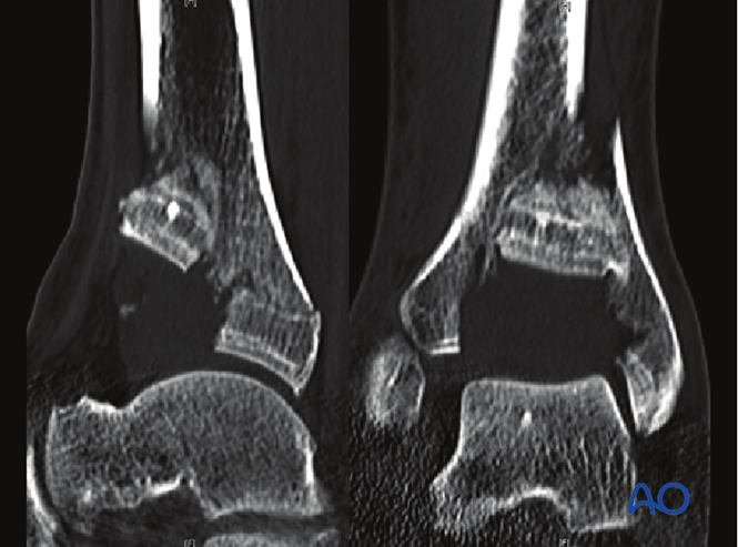 Anteromedial approach to the distal tibia
