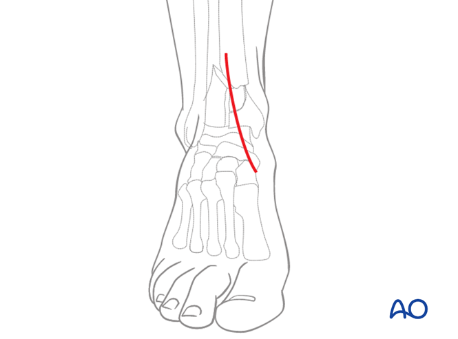 Anteromedial approach to the distal tibia