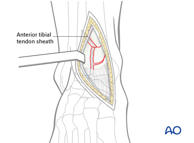 Anteromedial approach to the distal tibia
