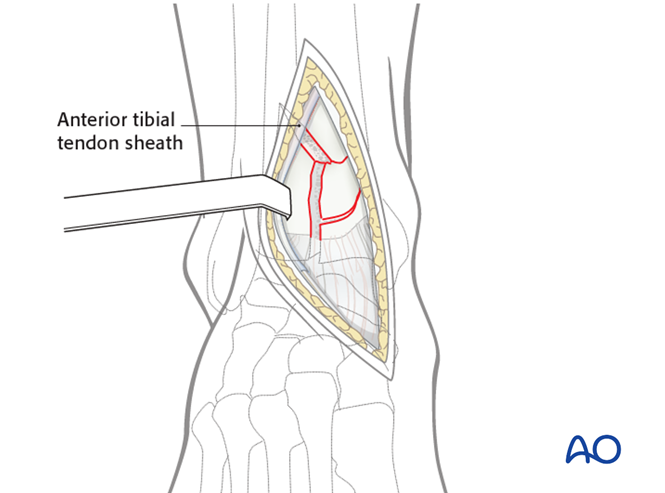 Anteromedial approach to the distal tibia