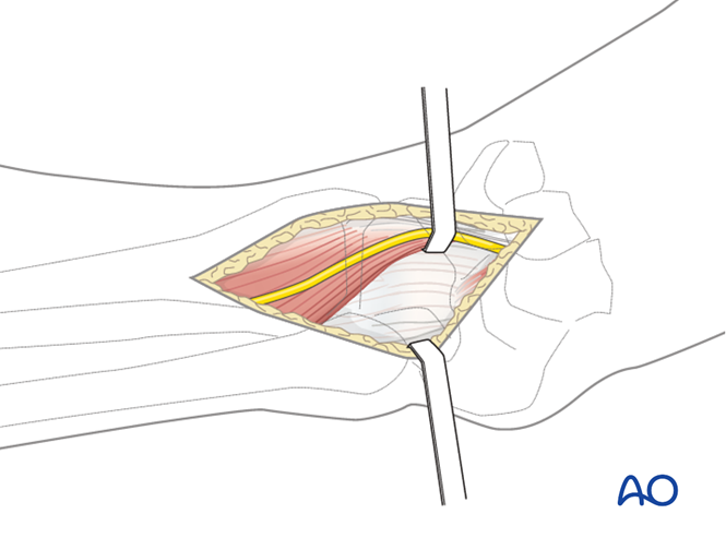 ORIF - Compression plate for Extraarticular, simple fracture