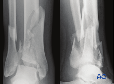 Anterolateral approach to the distal tibia