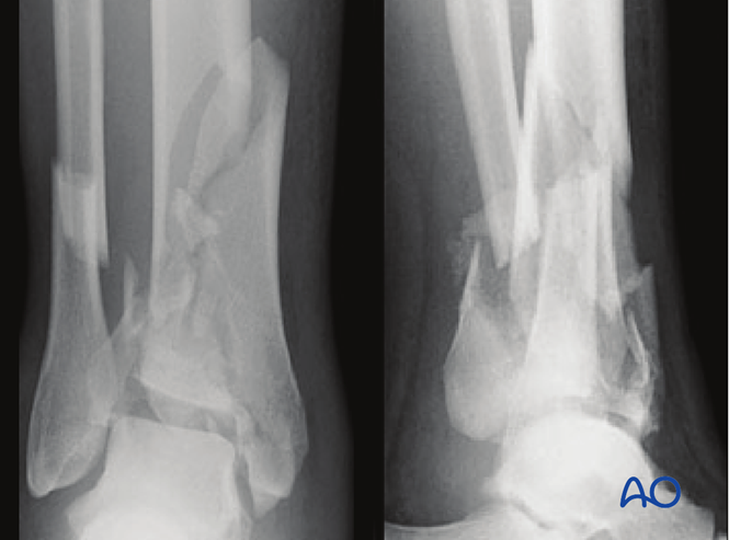 Anterolateral approach to the distal tibia